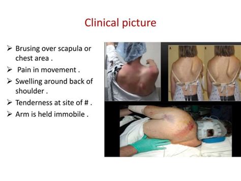 Clavicle And Scapular Fracture Pptx