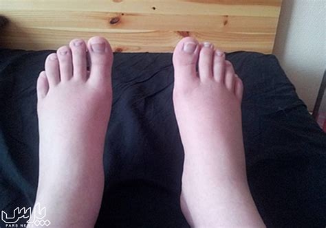 علت ورم پا چیست ؟ زنگ خطر کدام بیماری هاست