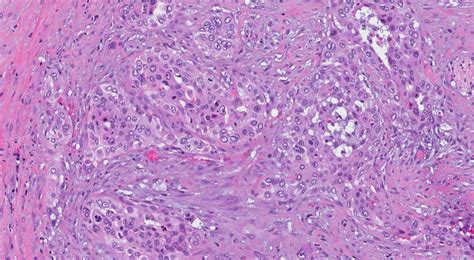 Adenosquamous Carcinoma Of The Pancreas Ottawa Atlas Of Pathology