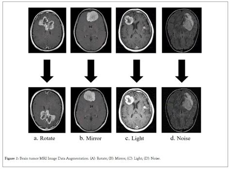 Improved Mask Rcnn Network For Brain Tumor Mri Image Instance Seg