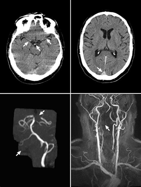 The Diffuse Hyperdense Intracranial Circulation Sign Pmc