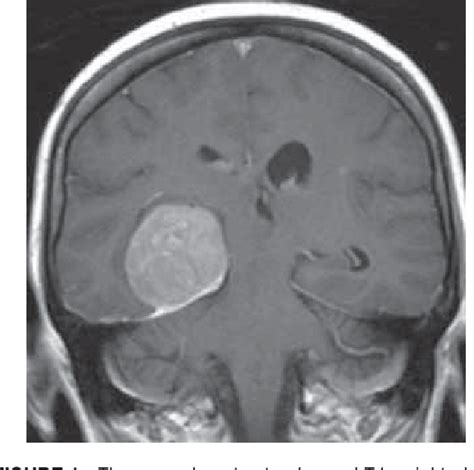 Figure 1 From Dural Tail Sign Adjacent To Different Intracranial