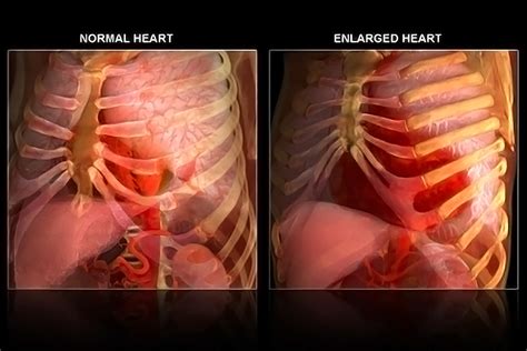 Enlarged Heart Compared To Normal Heart