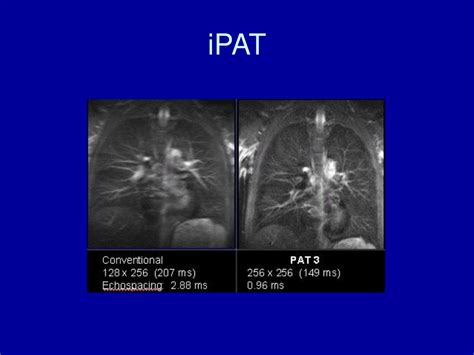 ppt parallel imaging making sense of grappa powerpoint presentation