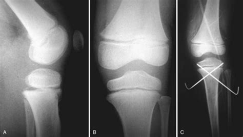 Physeal Fractures About The Knee Musculoskeletal Key