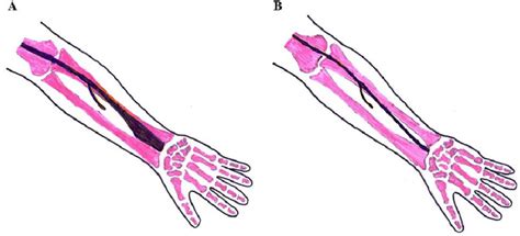 A B Hand Drawn Sketch Showing The Pattern Of Median Nerve