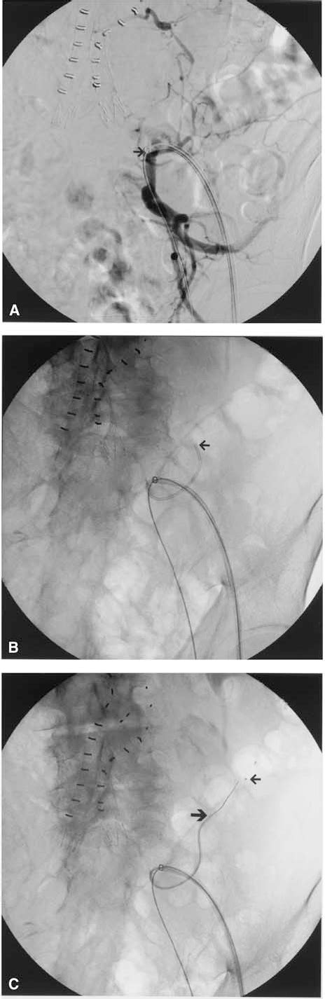 Figure 1 From Technique And Results Of Transfemoral Superselective Coil
