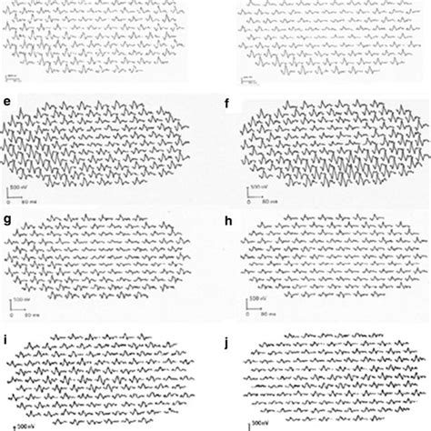 Serial Humphrey Visual Field 24 2 Total And Pattern Deviation Plot At