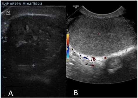 A Right Testes With Diffuse Low Echotexture And No Vascularity On Download Scientific Diagram