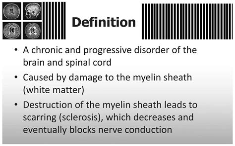 Multiple Sclerosis Ppt
