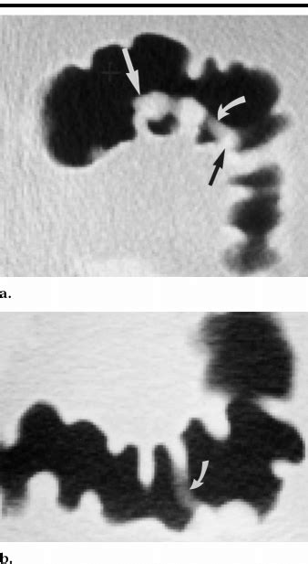 A Pedunculated Polyp Colonoscopically Proved Is Shown By Using Prone
