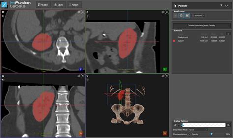 volume measurement in ct general and how to imfusion support forum