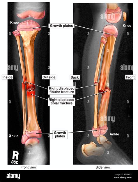 Right Tibia Fracture