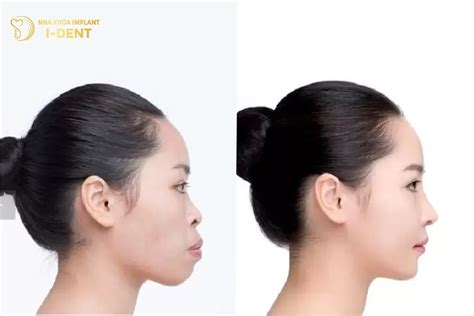 Trước Và Sau Khi Niềng Răng Có Làm Thay Đổi Khuôn Mặt