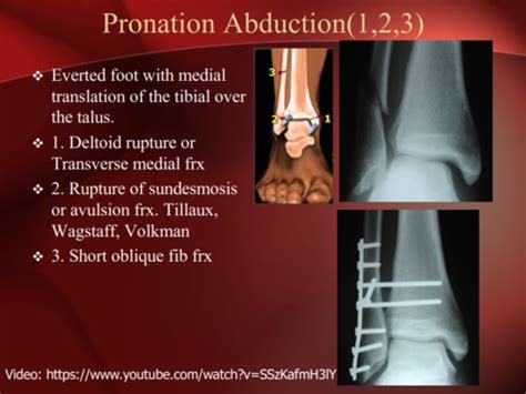 Pronation Abduction Ankle Fracture