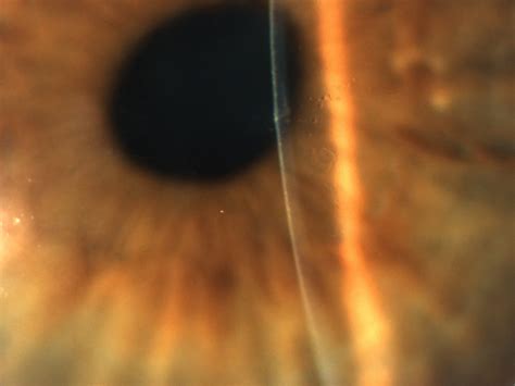 Map Dot Fingerprint Dystrophy