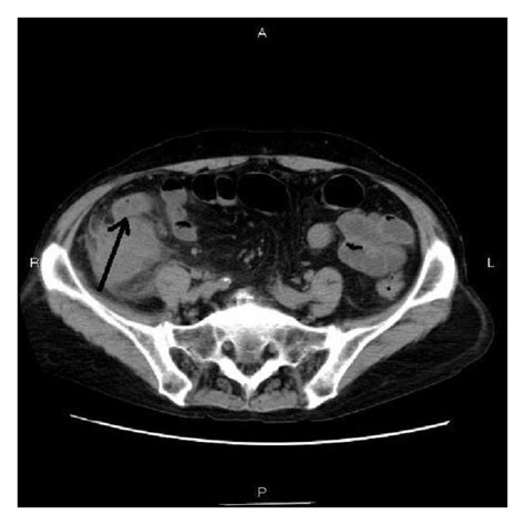 Abdominal CT The Appendix Shows A Mass Measuring 5 4 4 Cm The Download Scientific Diagram