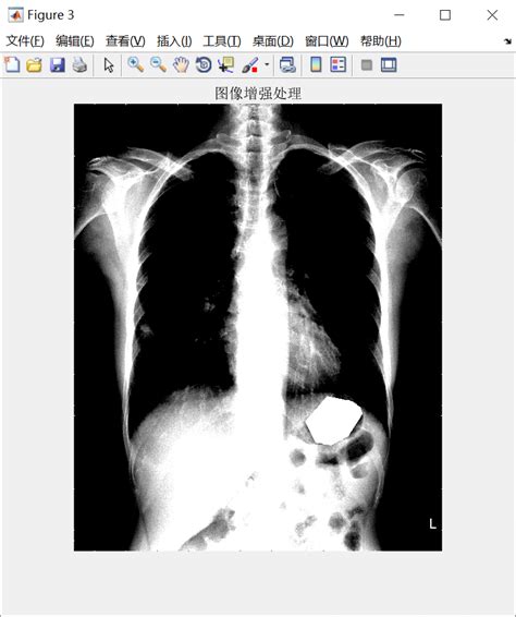 【深度学习】基于最小误差法的胸片分割系统（matlab代码实现）基于matabbiab编程使用最小值误差方法分割图像代码 Csdn博客