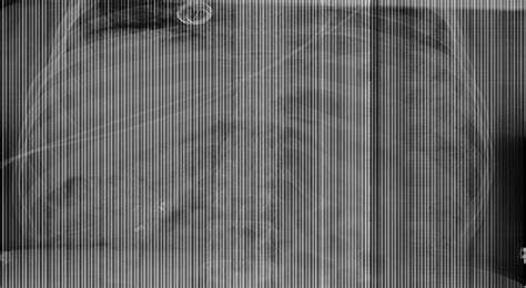 Pictorial Review Of Digital Radiography Artifacts RadioGraphics