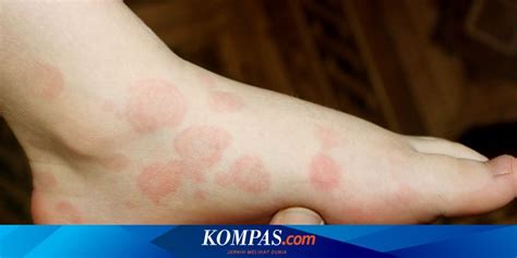 Penyakit Eritema Multiforme Gejala Penyebab Pengobatan Kompas Com