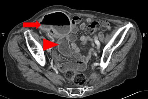 What Is Hepatic Flexure At Dorathy Quinones Blog