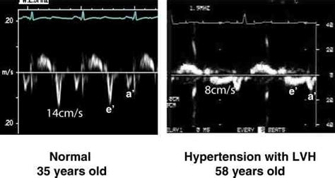 Tissue Doppler Td Recording From The Lateral Mitral Annulus From A
