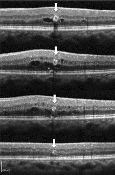 Characterization Of Microaneurysm Closure After Focal Laser Photocoagulation In Diabetic Macular