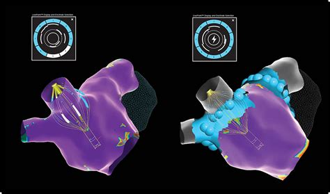 Volt Pulse Field Ablation Pfa System Abbott