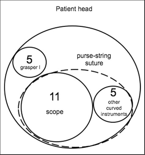 Figure 1 From Transumbilical Single Access Laparoscopic Perforated Gastric Ulcer Repair