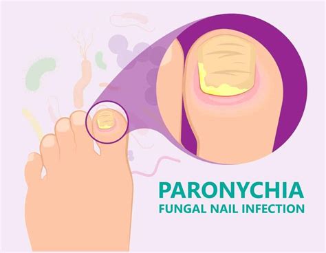 What Causes Toenail Fungus Find Out The Reasons