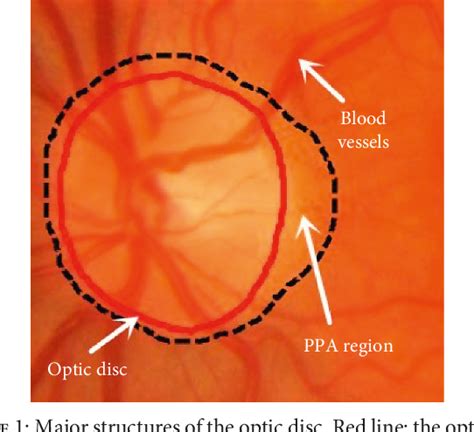 Figure 1 From Automatic Optic Disc Segmentation Based On Modified Local Image Fitting Model With