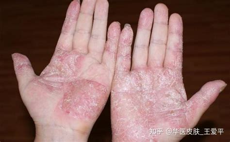 盘点手指上容易出现什么皮肤病手癣汗疱疹 知乎