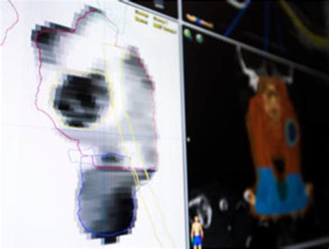 Planificación Imrt Simplificada