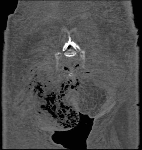 Necrotizing Fasciitis Without Bladder Involvement On Ct Cystogram