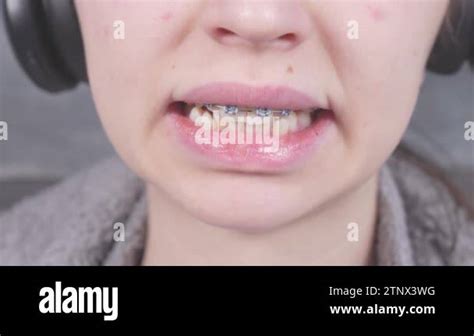Girl Touching Her Metal Braces With Tongue Close View Of The Mouth With Braces Orthodontics