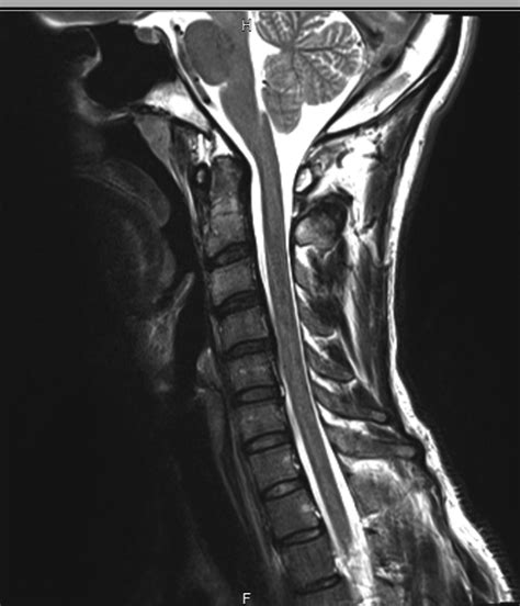 Mri Of The Cervical Spine After Treatment Revealing No Stenosis In The