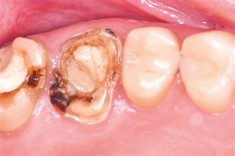 Synthetic Approach For Socket Preservation Dr E Mota Indication Matrix