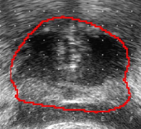 Limitations Of Trus Prostate Volume Segmentation A General Overview