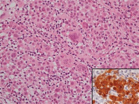 Solitary Tumor With A Peripheral Depigmented Patch And Poliosis