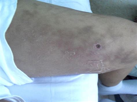 Criptococosis Diseminada Con Afectación Del Sistema Nervioso Central