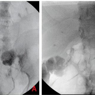 A Repeat Cystoscopy Left Retrograde Pyelogram With Persistent Distal Download Scientific