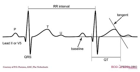 Normal Qrs Time