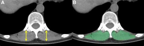 Measurements Of The Cross Sectional Area Of Skeletal Muscles On Download Scientific Diagram