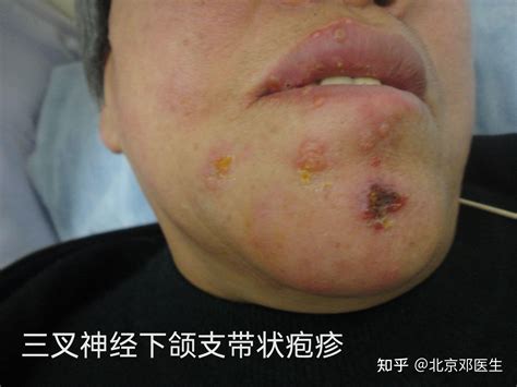 头上长的带状疱疹疼起来最要命也最容易留后遗症 知乎
