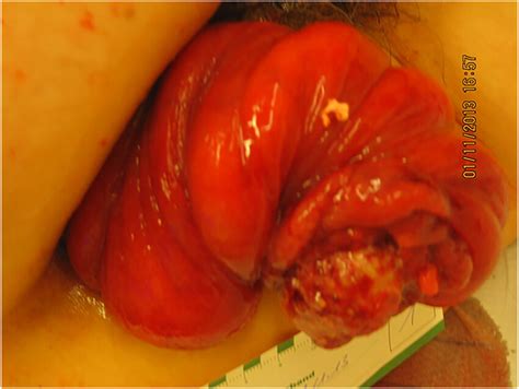 Clinical Manifestation Of Rectal Prolapse With Exulcerated Rectal
