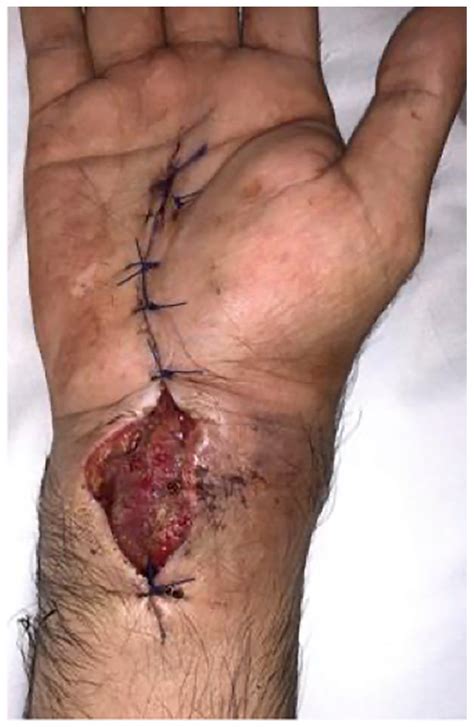 Clinical Photograph Of Soft Tissue Defect Measuring Approximately