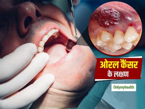 Symptoms Of Oral Cancer And Their Precautions In Hindi ओरल कैंसर के