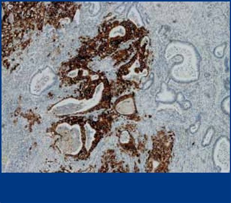 Figure 2 From Belgian Guidelines For Her2 Testing In Gastric Cancer