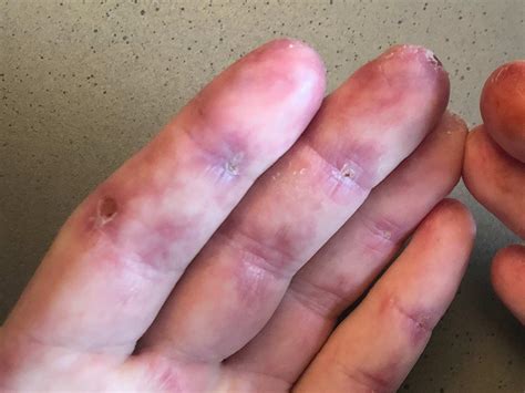 Dermatomyositis Understanding The Symptoms And Causes Myositis