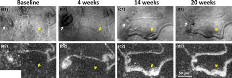Capillary Dilation After Recanalisation And Reperfusion Magnified